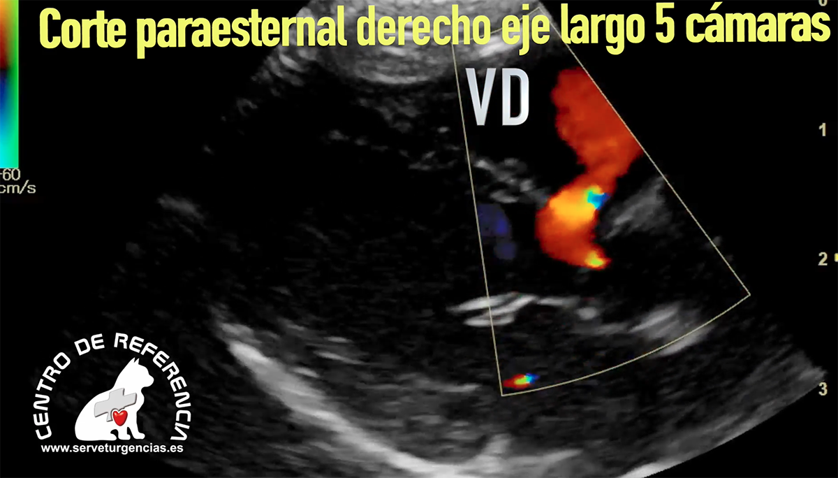 Defecto del septo ventricular